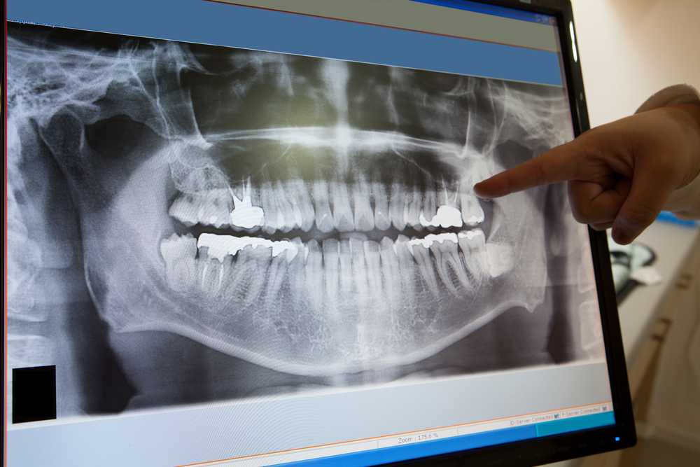 Digital Radiography at Boston Smile Center: Why We Use Digital X-Rays ...